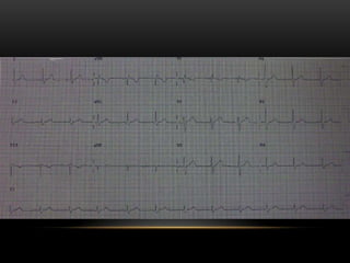 Endocarditis Ecg