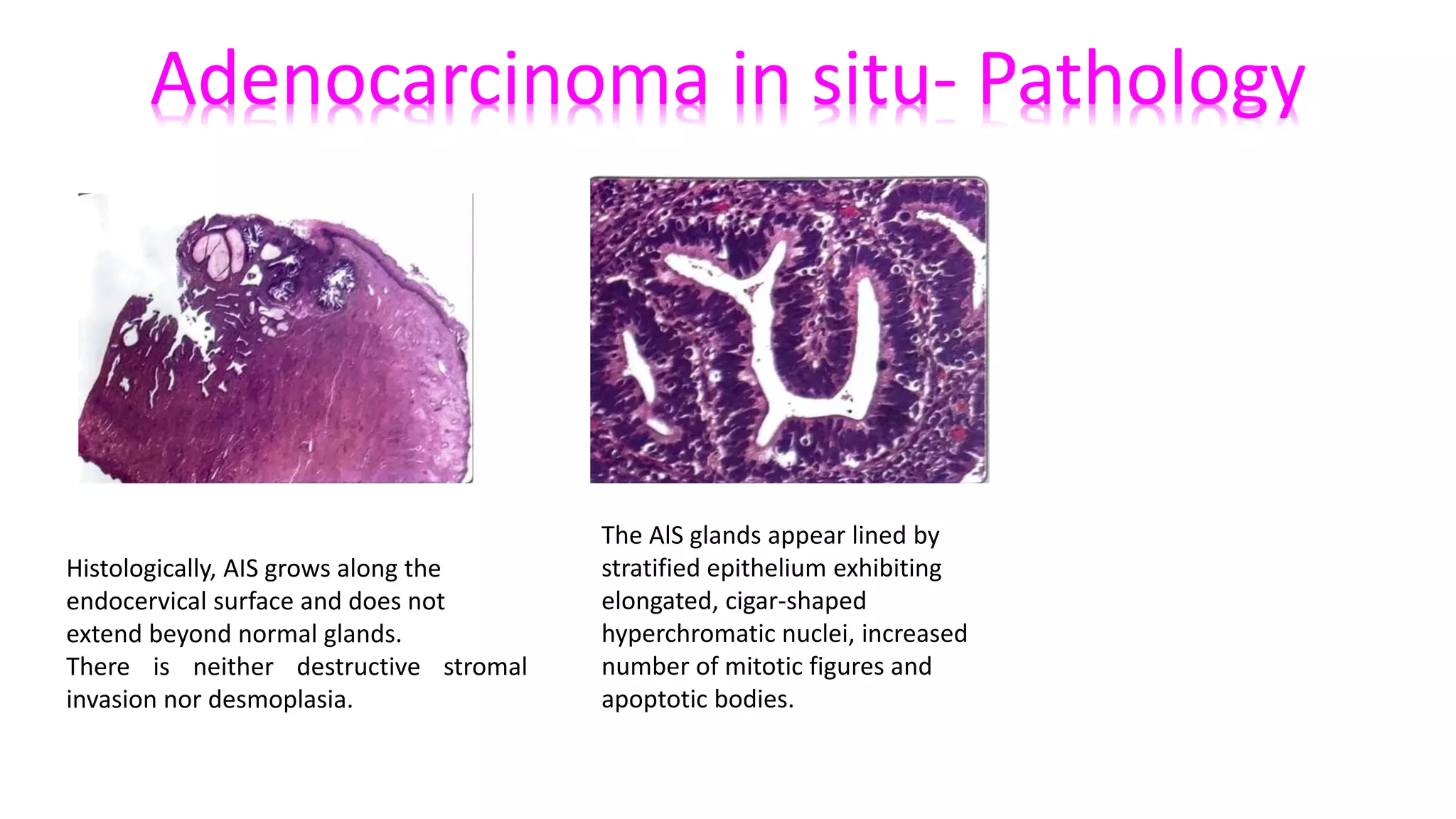 Diagnostic challenges in endocervical adenocarcinoma | PPTX