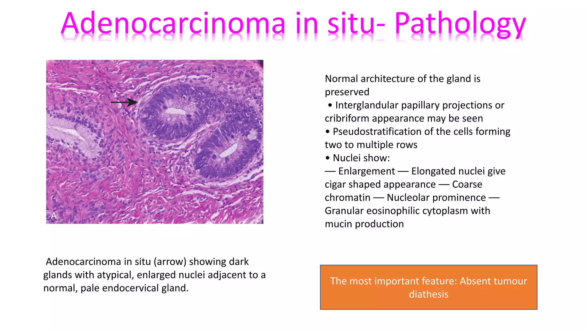 Diagnostic challenges in endocervical adenocarcinoma | PPTX