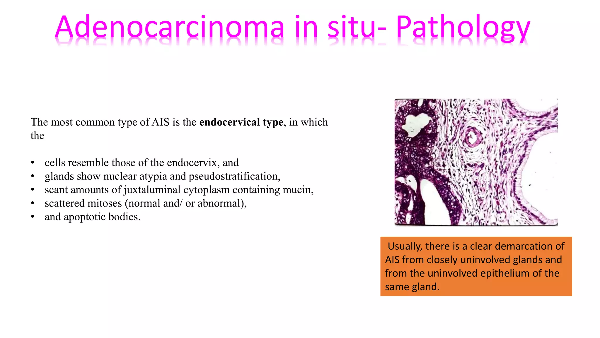 Diagnostic challenges in endocervical adenocarcinoma | PPTX