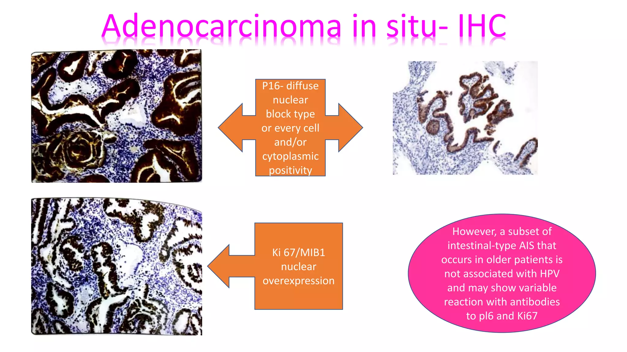 Diagnostic challenges in endocervical adenocarcinoma | PPTX