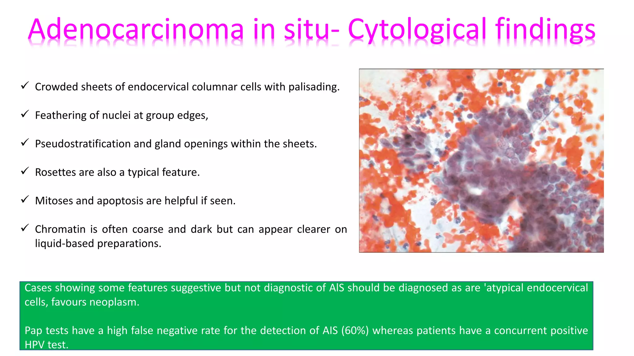 Diagnostic challenges in endocervical adenocarcinoma | PPTX