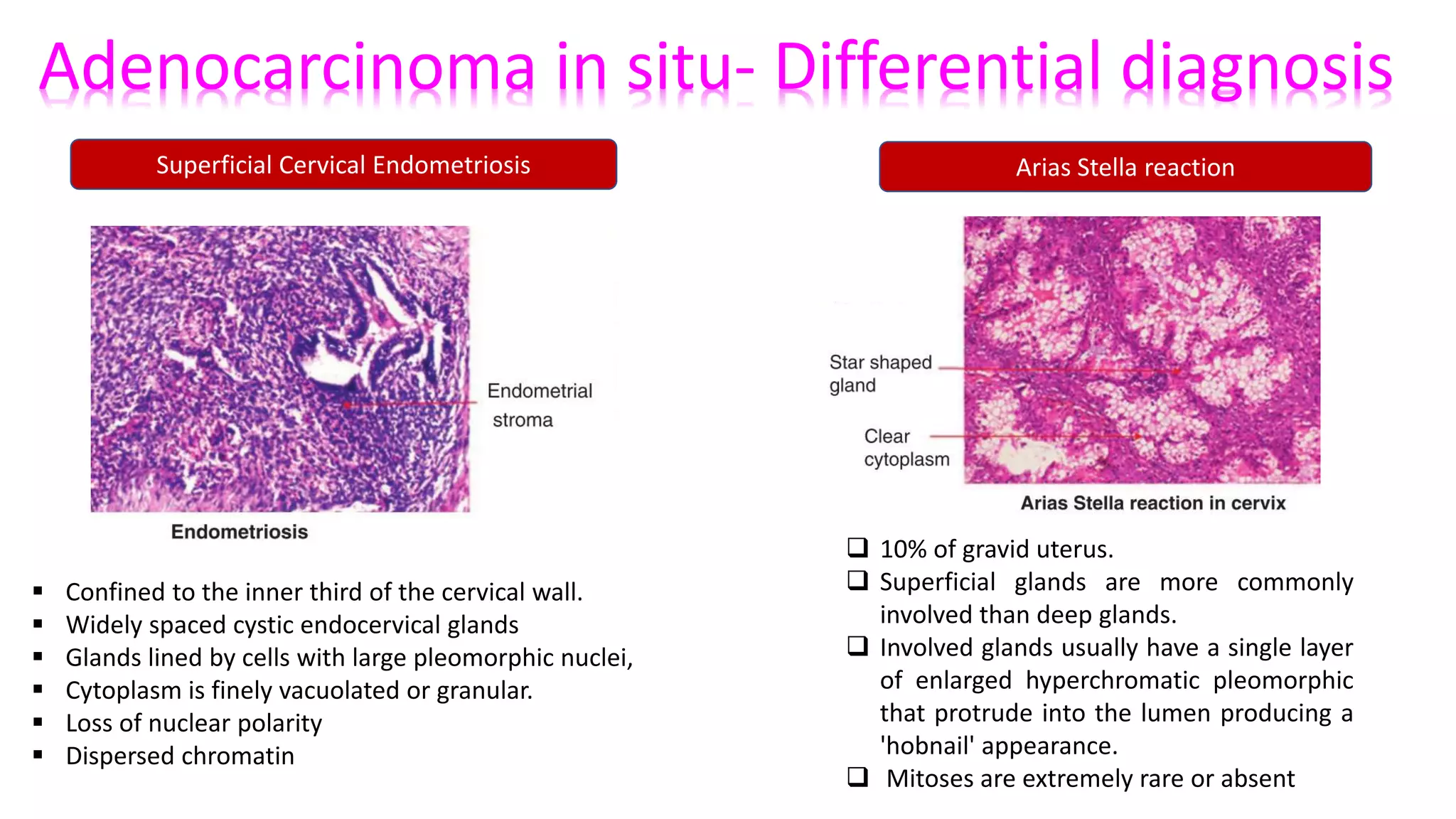 Diagnostic challenges in endocervical adenocarcinoma | PPTX