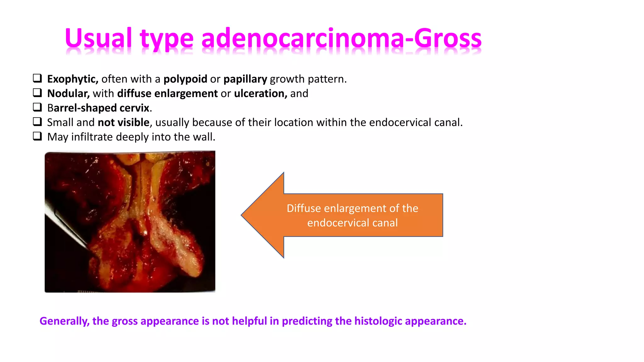 Diagnostic challenges in endocervical adenocarcinoma | PPTX