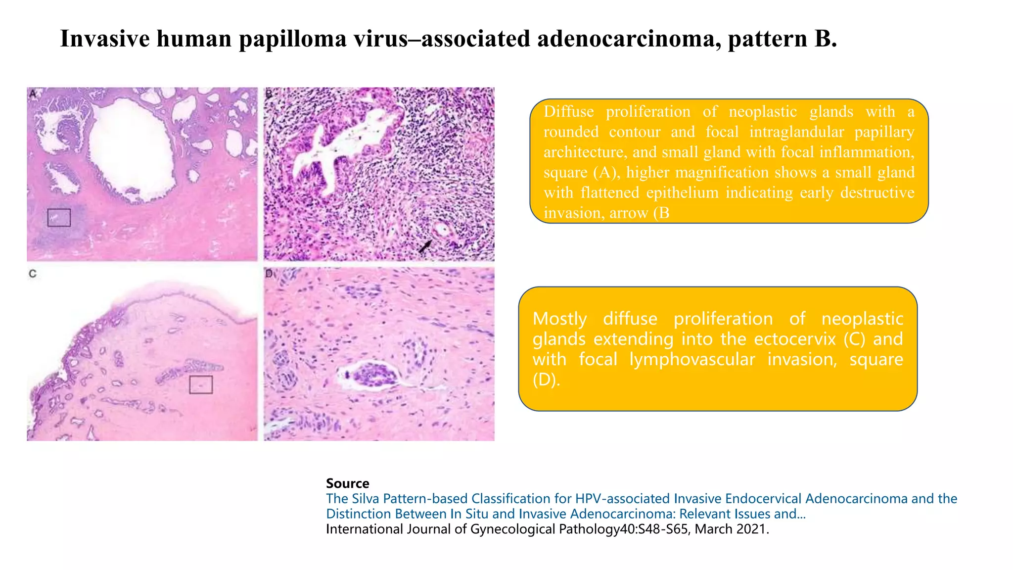 Diagnostic challenges in endocervical adenocarcinoma | PPTX