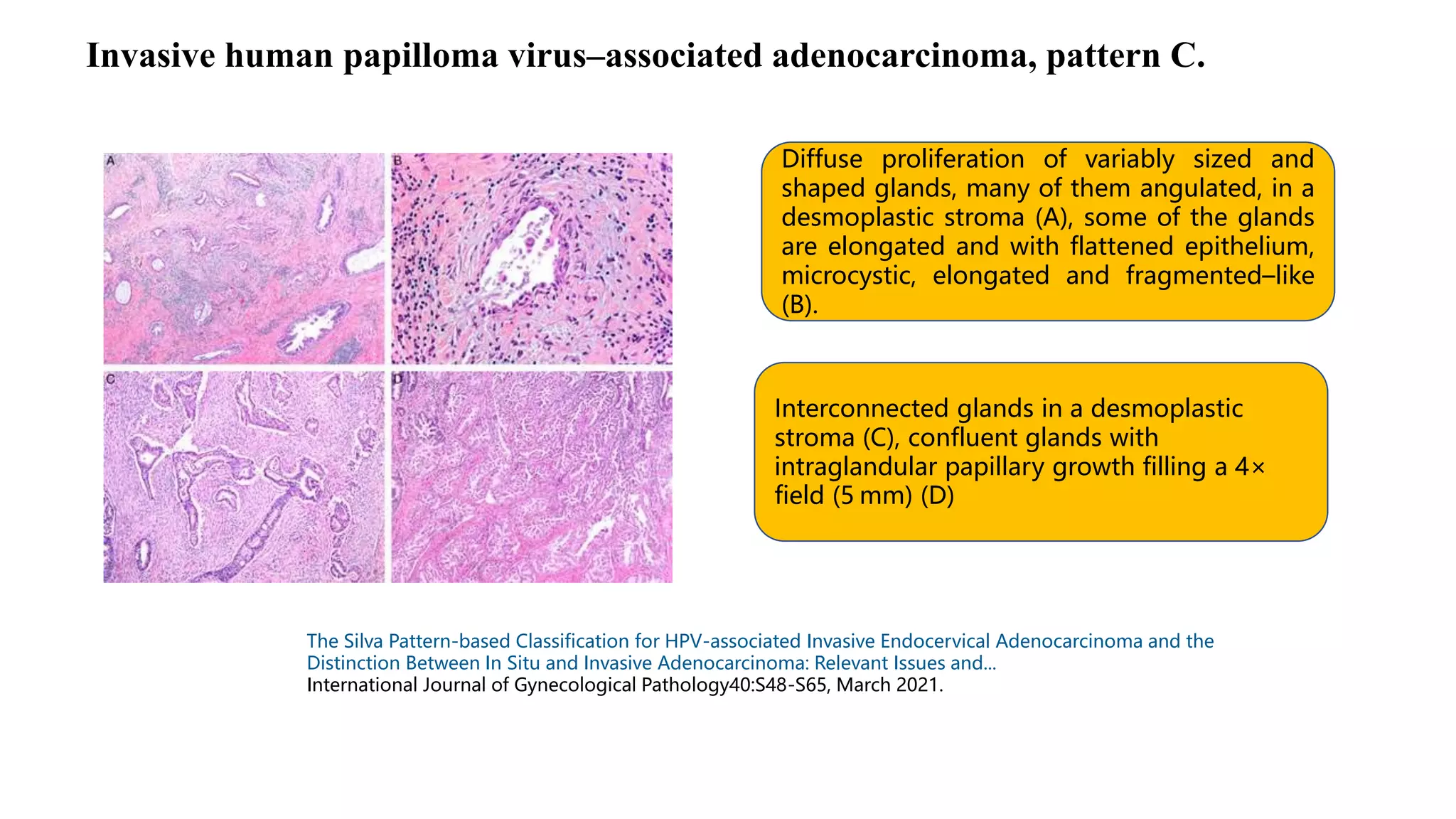 Diagnostic challenges in endocervical adenocarcinoma | PPTX