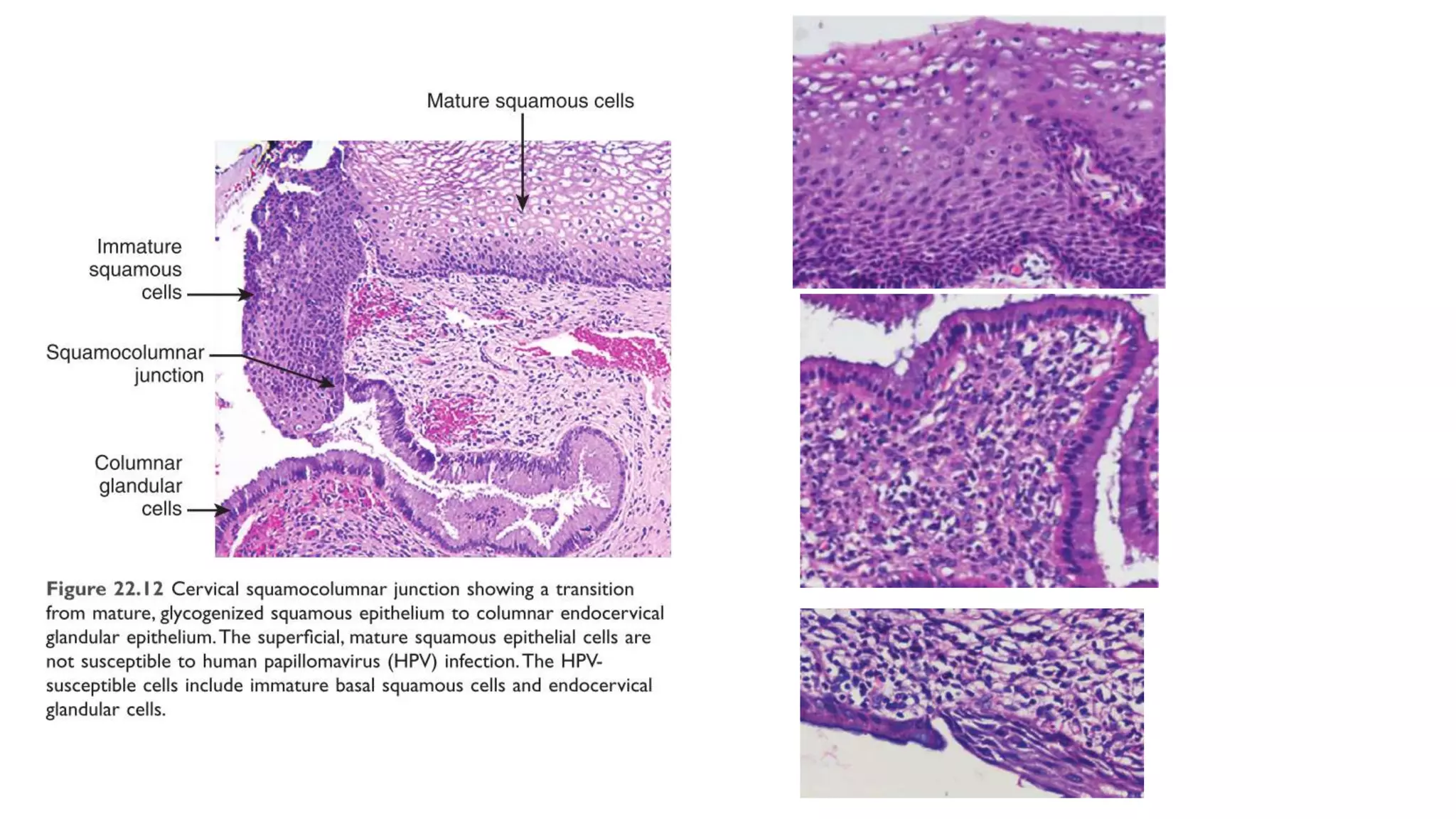 Diagnostic challenges in endocervical adenocarcinoma | PPTX
