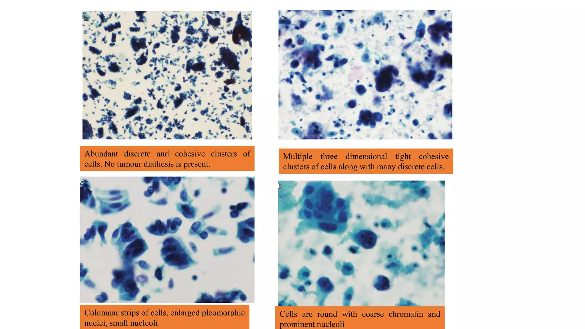 Diagnostic challenges in endocervical adenocarcinoma | PPTX