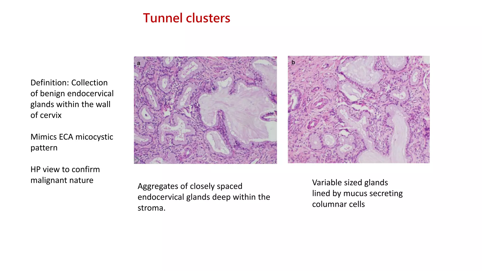 Diagnostic challenges in endocervical adenocarcinoma | PPTX