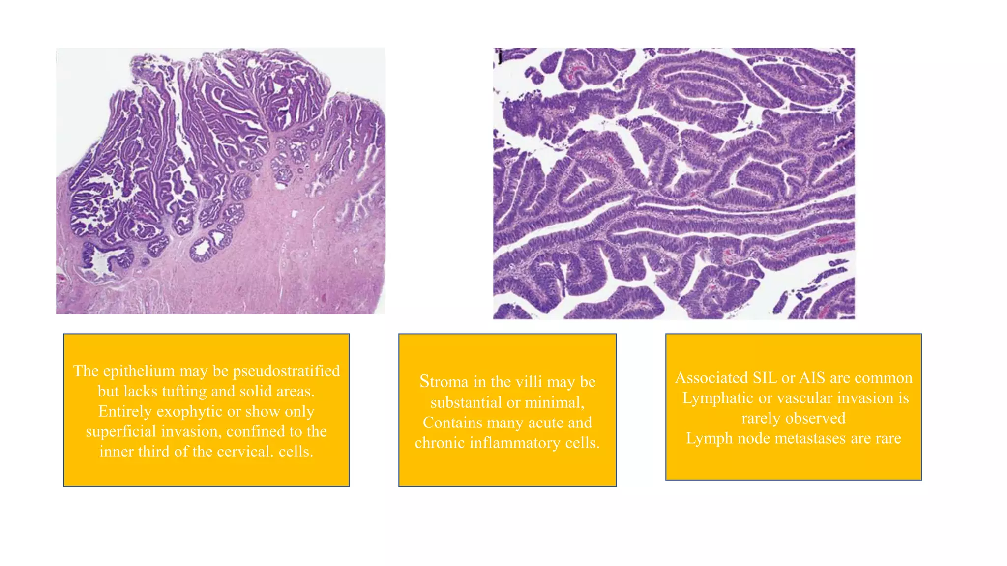 Diagnostic challenges in endocervical adenocarcinoma | PPTX