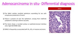 Diagnostic challenges in endocervical adenocarcinoma | PPTX