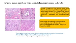 Diagnostic challenges in endocervical adenocarcinoma | PPTX