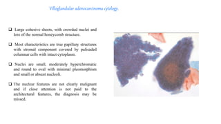 Diagnostic challenges in endocervical adenocarcinoma | PPTX
