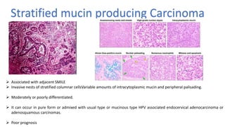 Diagnostic challenges in endocervical adenocarcinoma | PPTX