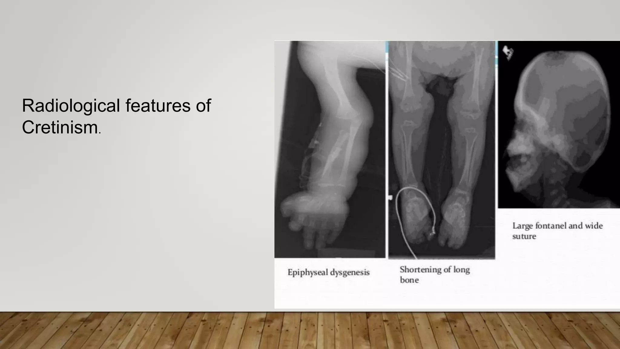 Endocrinal abnormalities of musculoskeletal system | PPTX