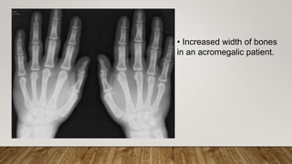 Endocrinal abnormalities of musculoskeletal system | PPTX