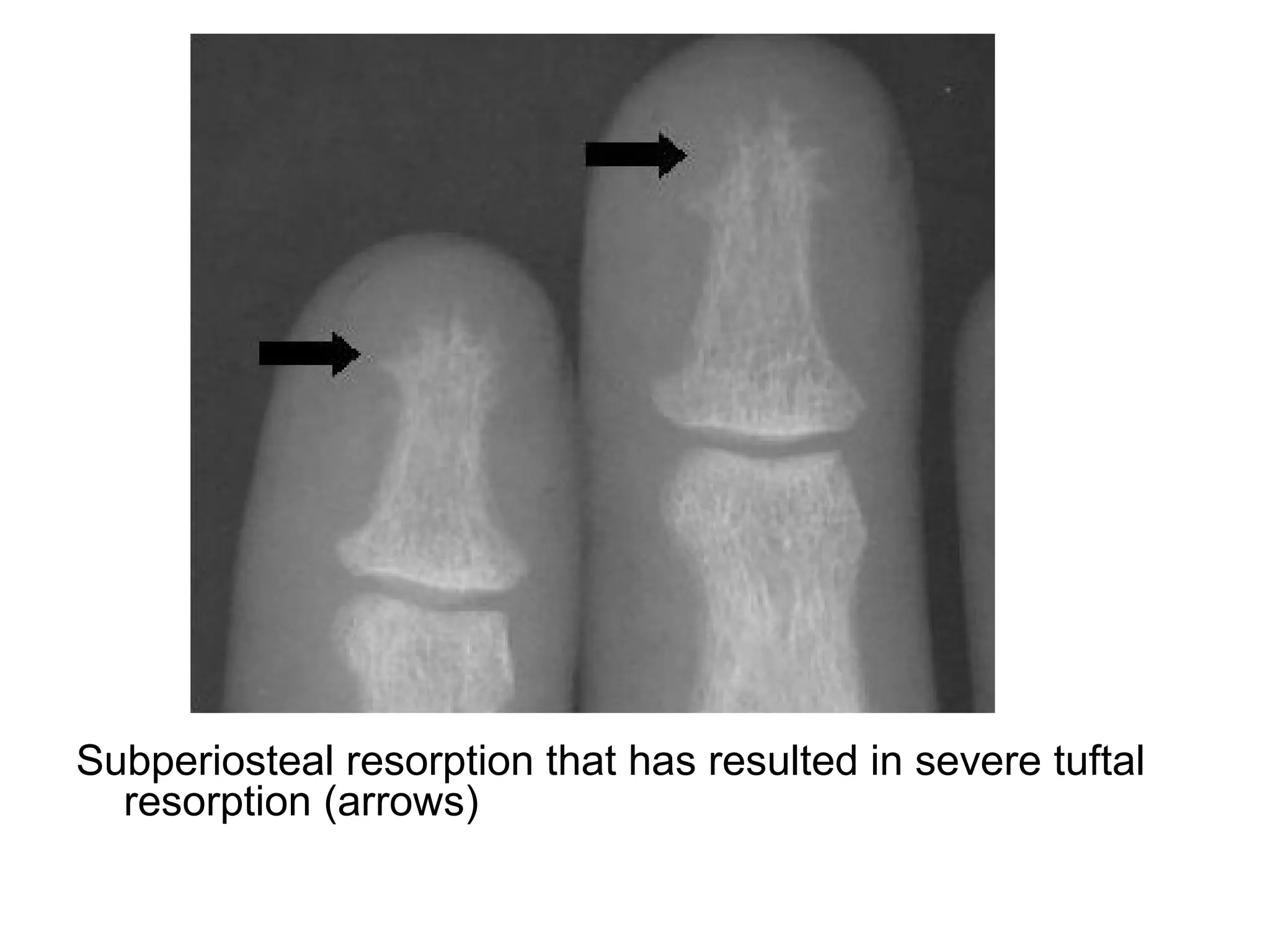 Diagnostic Imaging of Endocrine bone disease | PPT