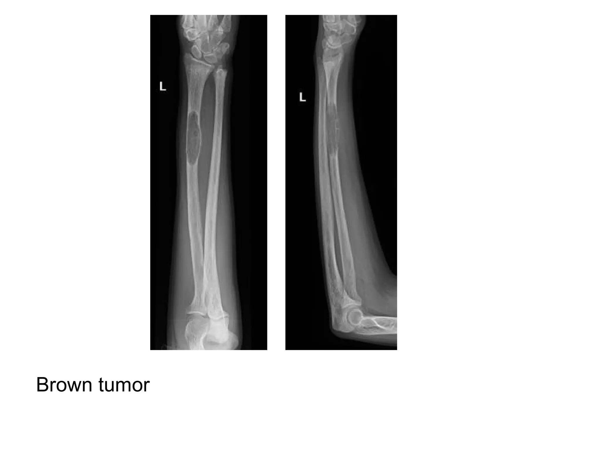 Diagnostic Imaging of Endocrine bone disease | PPT