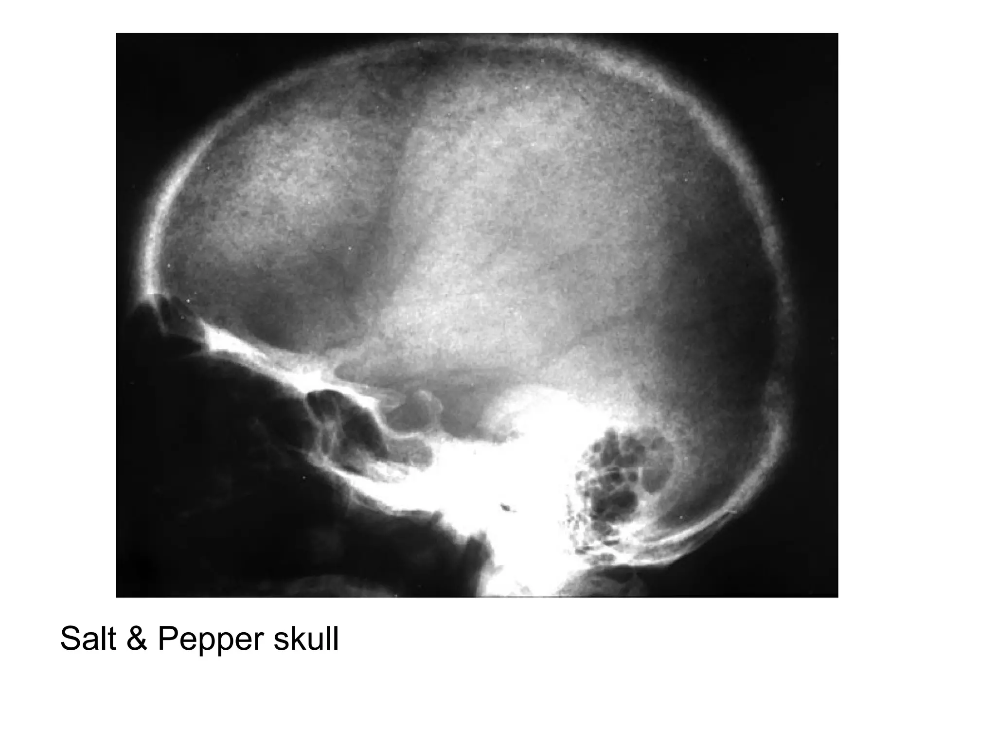 Diagnostic Imaging of Endocrine bone disease | PPT