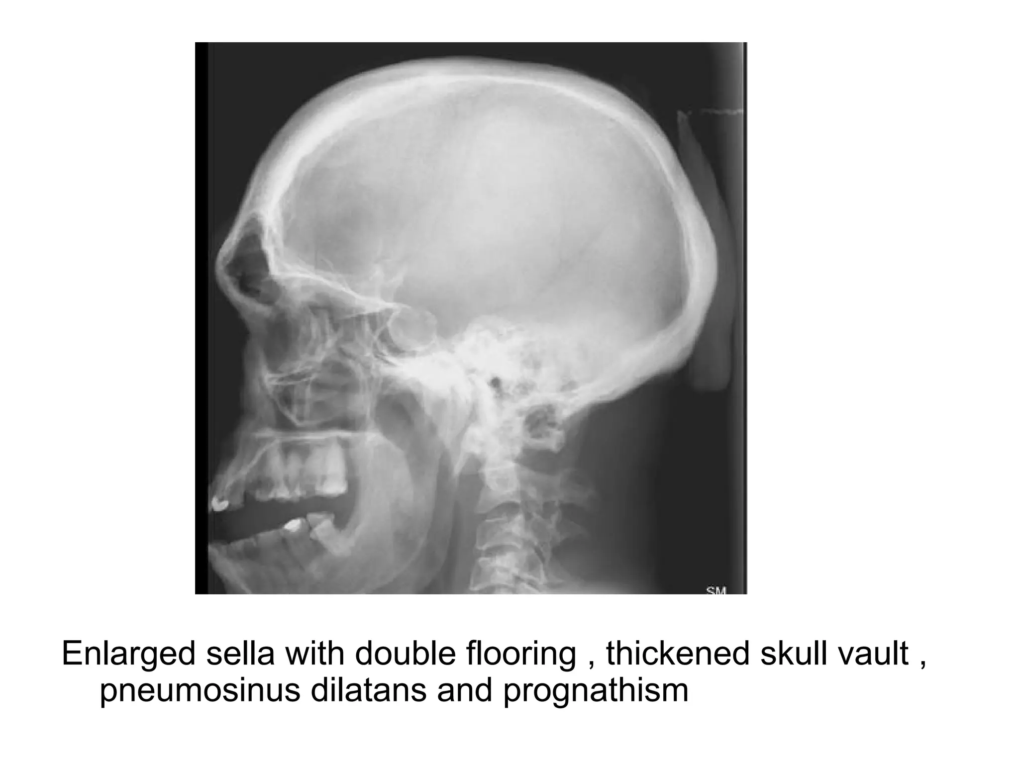 Diagnostic Imaging of Endocrine bone disease | PPT
