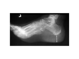 Diagnostic Imaging of Endocrine bone disease | PPT