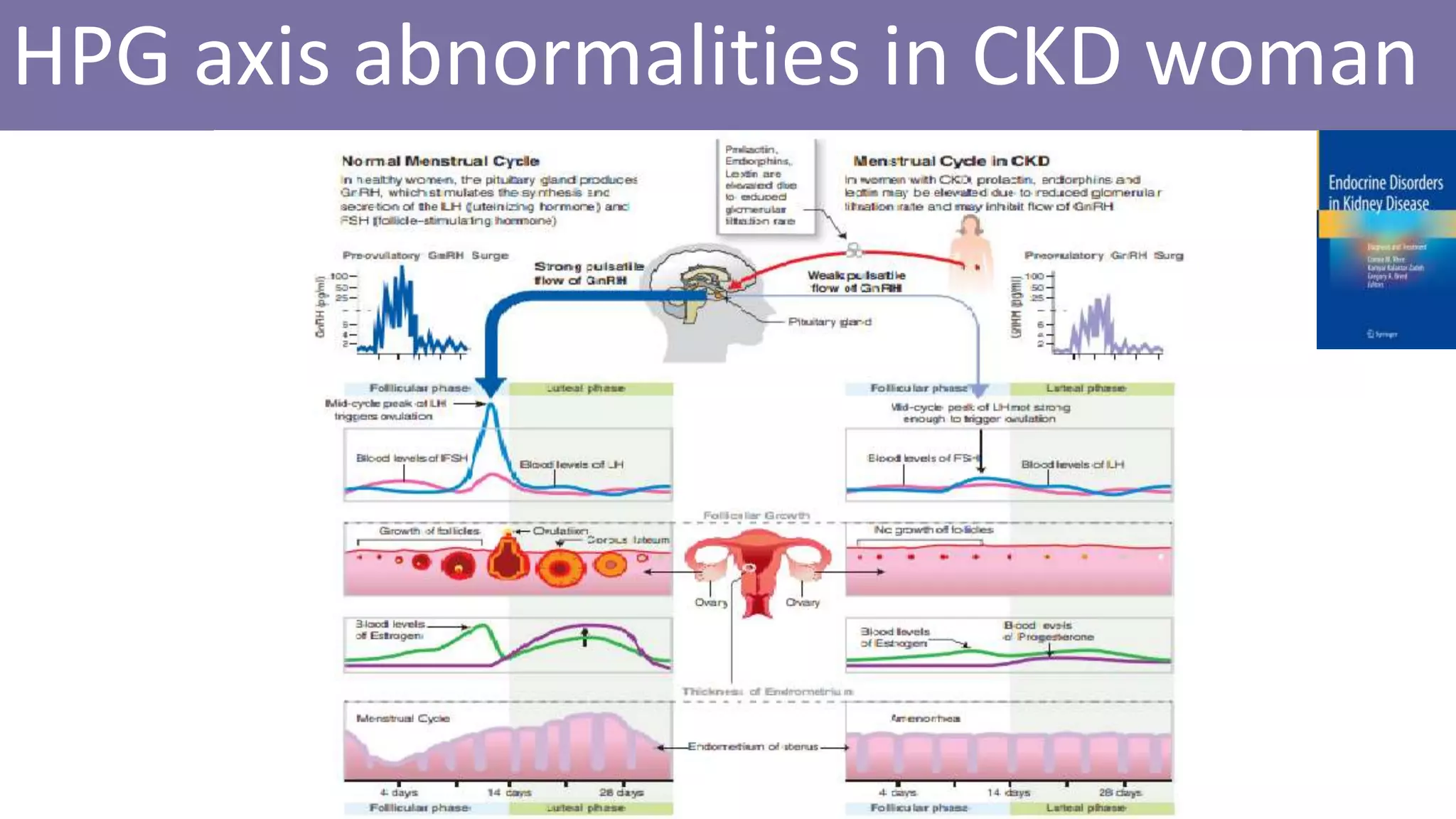 Endocrine disorders in CKD | PPTX