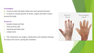 endocrine disorders.ppt presented by gayathrimaripandiyam | PPTX