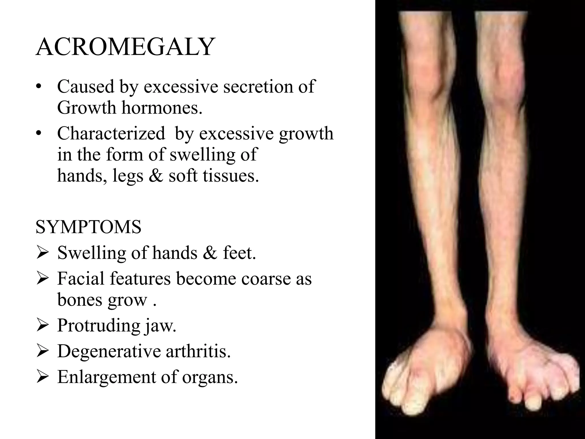 Endocrine disorders | PPTX