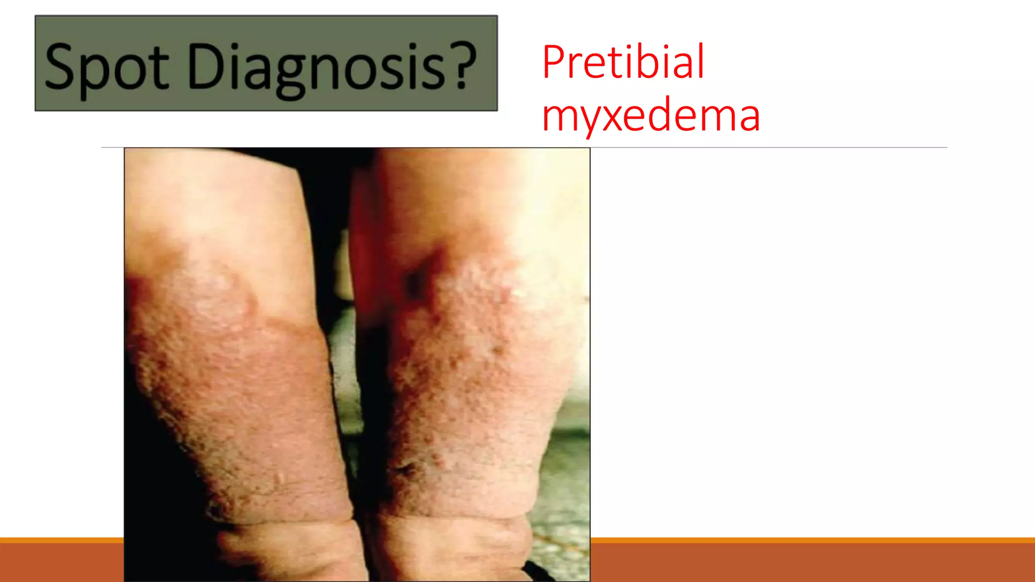 Endocrine emergency cases | PPTX