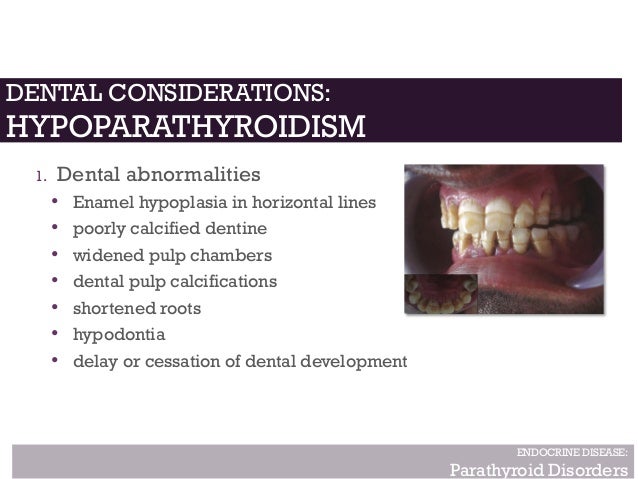 Hypoparathyroidism Teeth