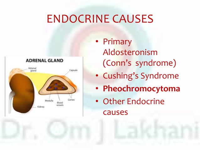 Endocrine causes of hypertension | PPTX | Hormonal Disorders ...