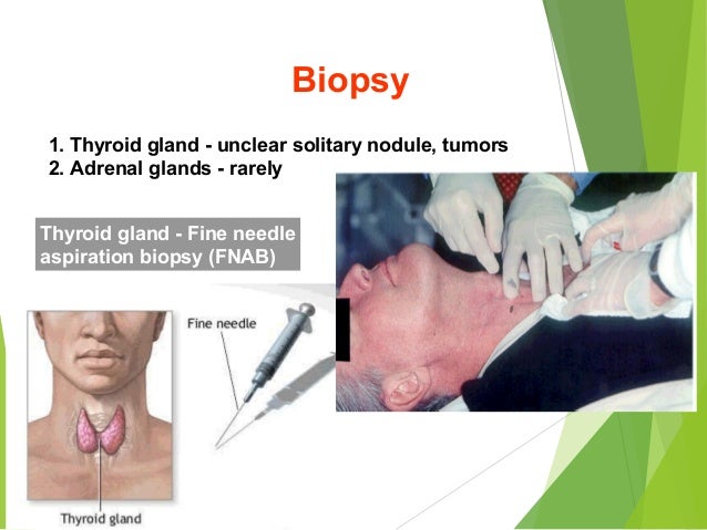 Enlarged Thyroid Gland Biopsy