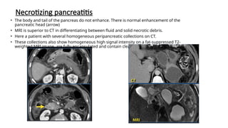 Endocrine pancreas /computerized Tomography and MRI | PPT