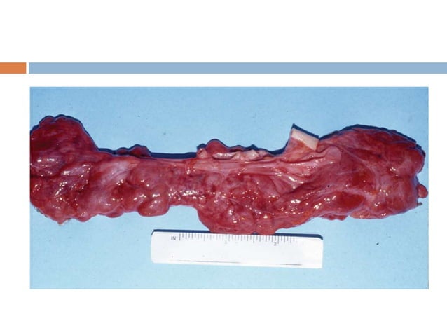 Endocrine pathology | PPTX