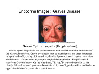 Images of Endocrine Disorders | PDF