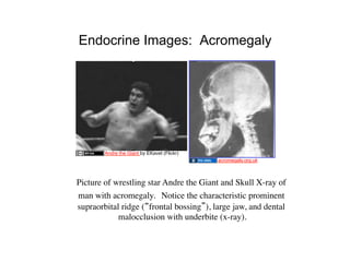 Images of Endocrine Disorders | PDF