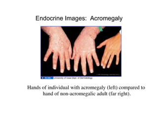 Images of Endocrine Disorders | PDF