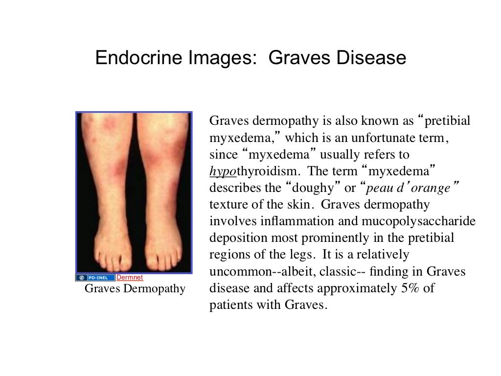 Endocrine Disorders