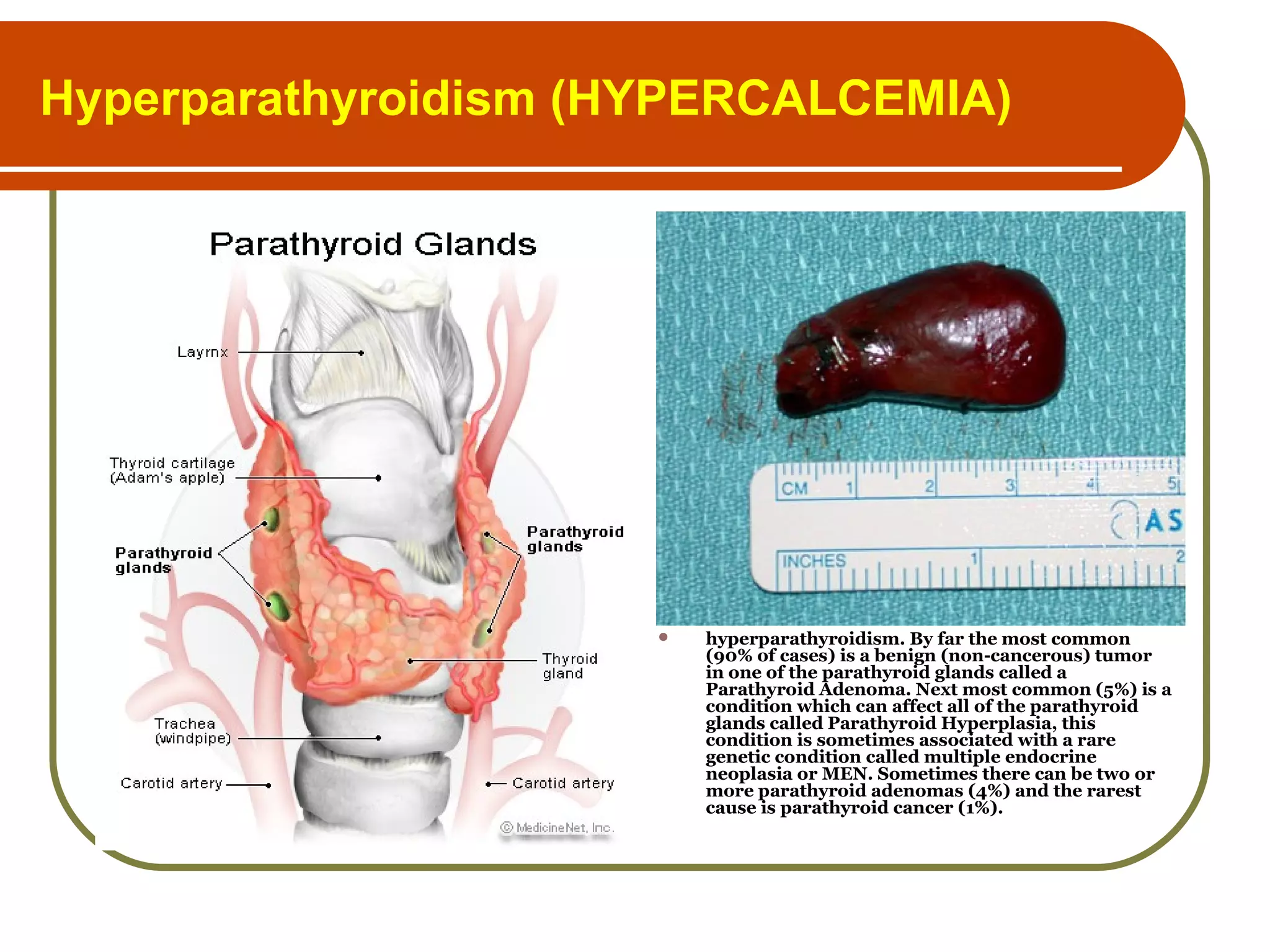 Endocrine Sys. (Hypercalcemia) | PPT