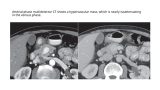 endocrine tumor of pancreas [Autosaved].pptx