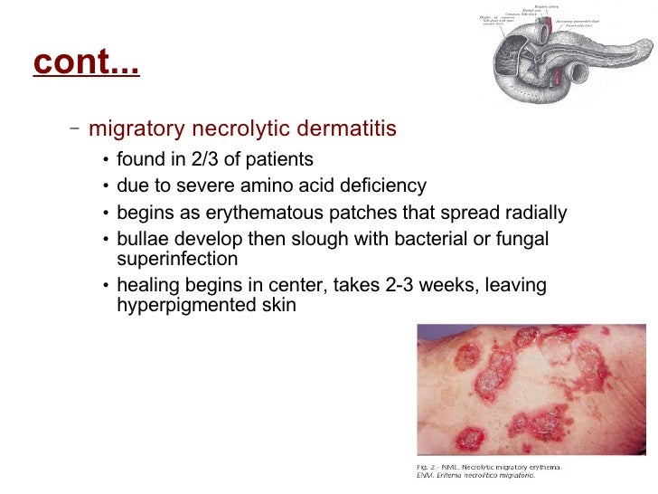 Endocrine Tumors Of The Pancreas