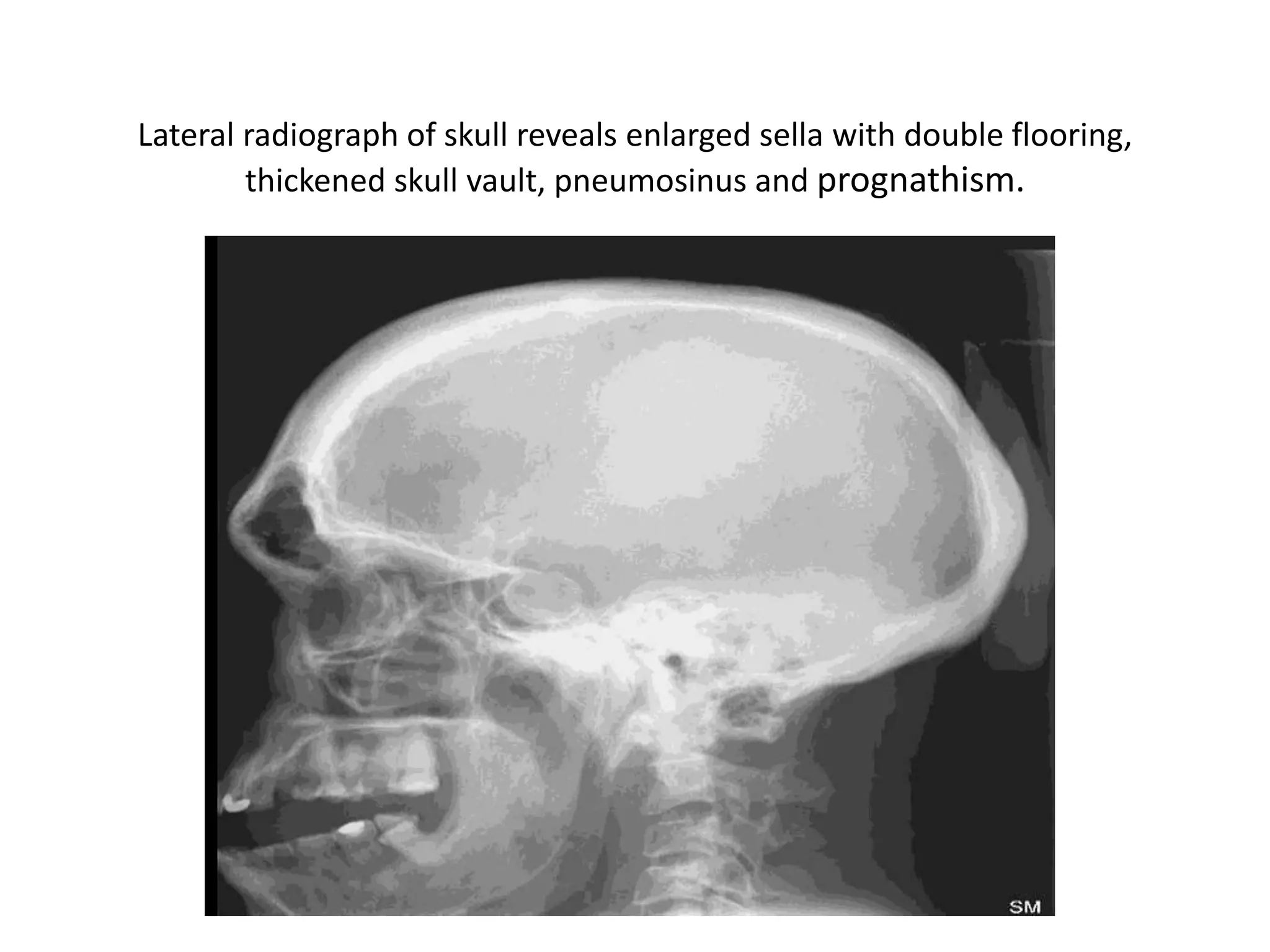 Acromegaly | PPTX | Endocrine and Metabolic Diseases | Diseases and ...