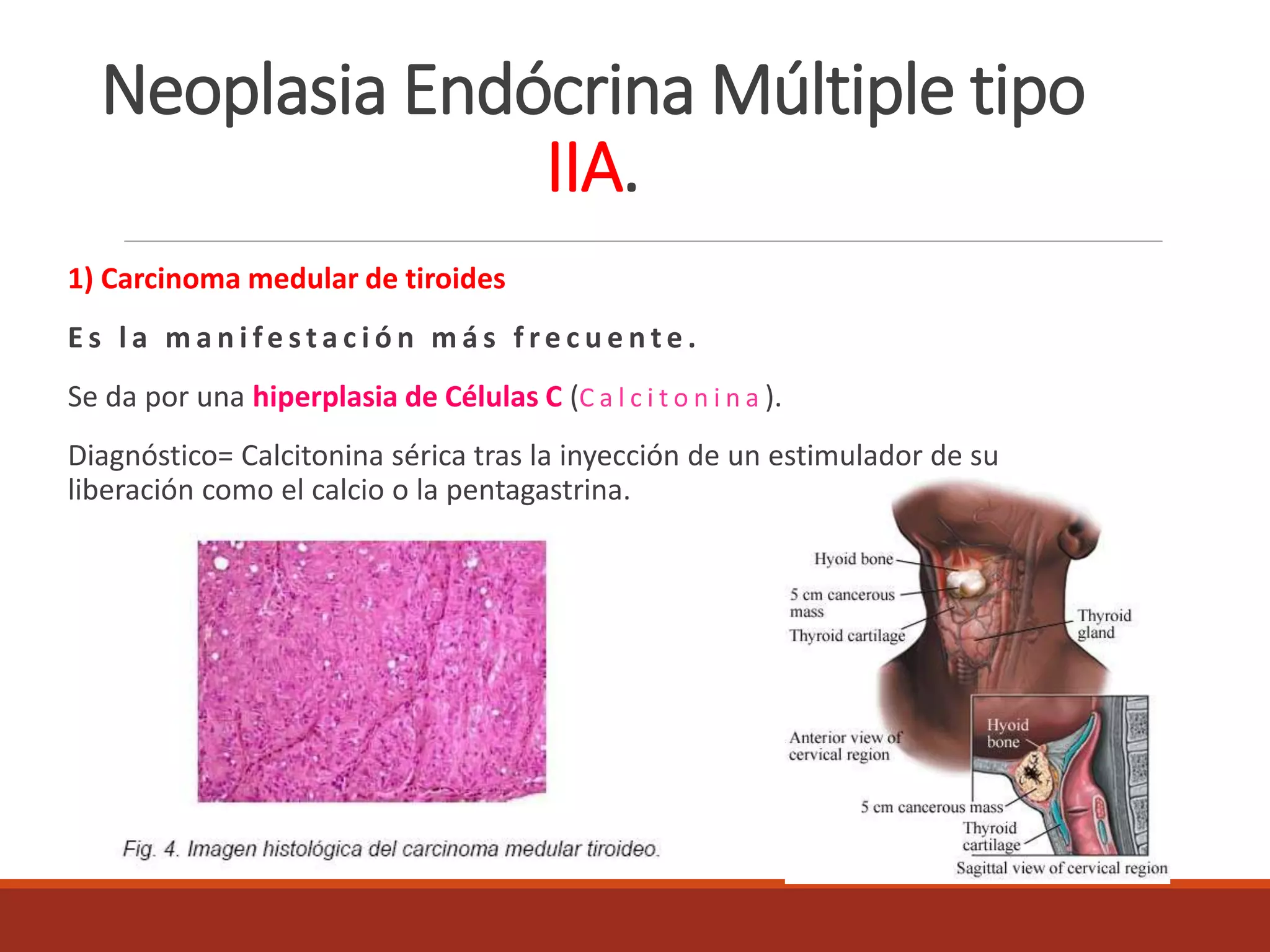 endocrinopatia neoplasica multiple | PPTX