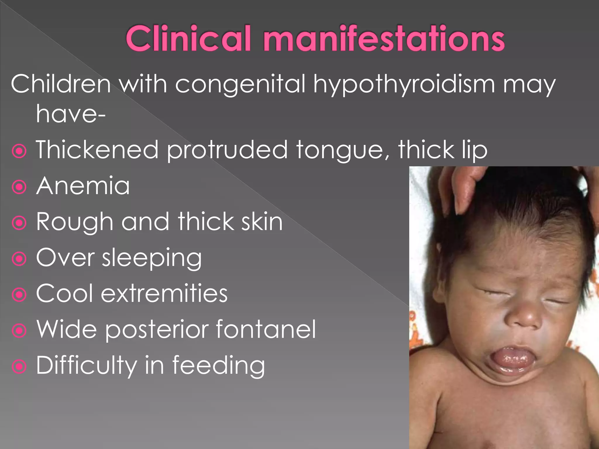 disorders of Endocrine in Children | PPTX