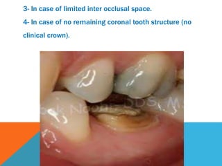 Endocrown | PPTX