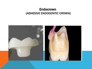 Endocrown | PPTX
