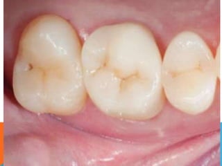 Endocrown | PPTX