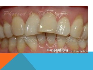 Endocrown | PPTX
