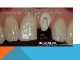 Endocrown | PPTX