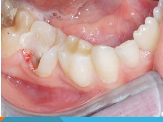 Endocrown | PPTX
